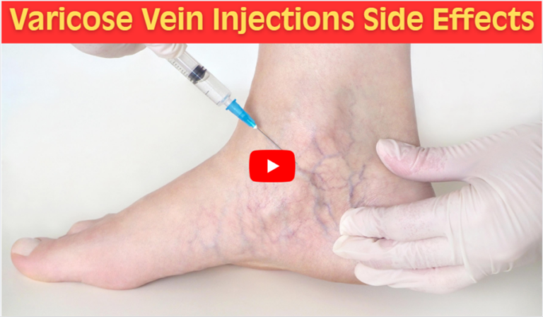 Varicose Vein Injections Side Effects: Explained!